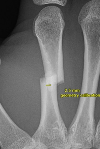 Use of NX Nail for oblique fracture fixation of 2nd metacarpal